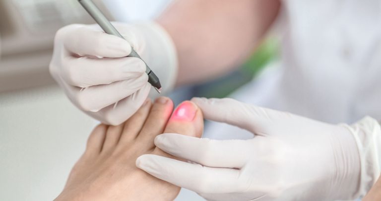 Tratamiento láser para la onicomicosis. Uñas sanas y bonitas todo el ...